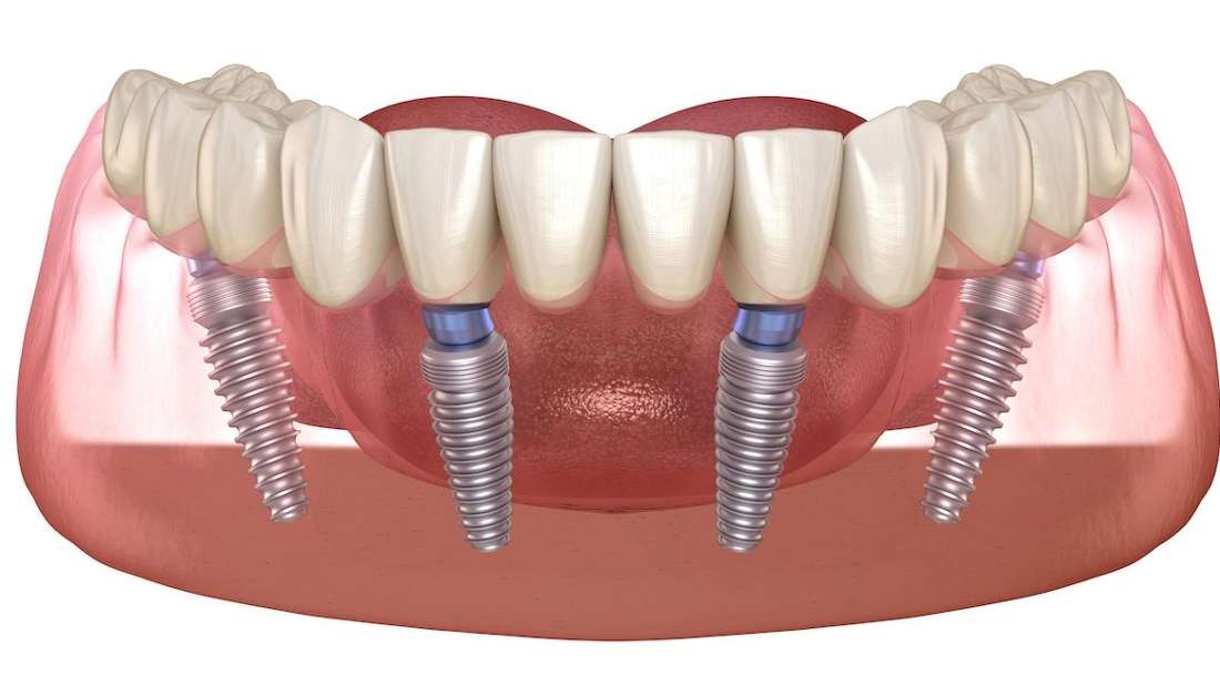 All-on-4® Dentures from Start to Finish | All-on-4® Implant Teeth Elk ...
