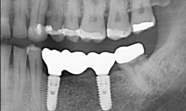 Before & After Photos | Dental Implants Gallery | Elk Grove CA