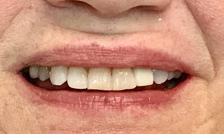 Elk Grove CA Dentist | Before & After Photos
